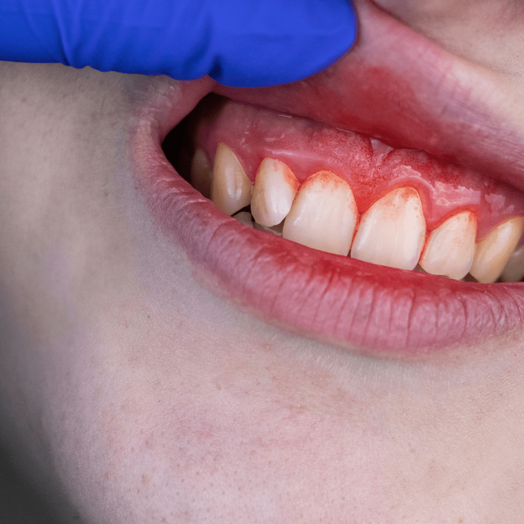 Bleeding Gums: What You Need to Know - Best Dental Clinic in BTM Layout ...