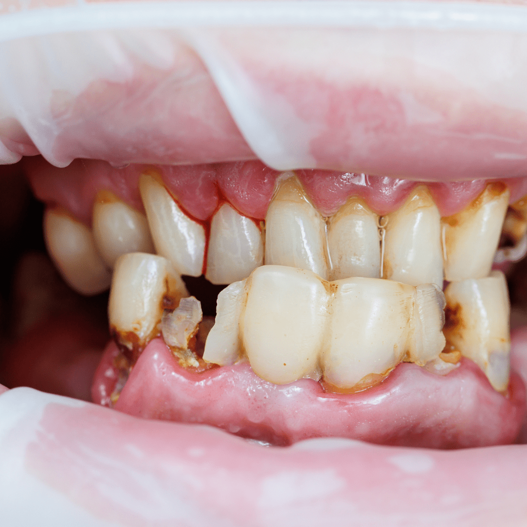 Swollen Gums: Causes, Symptoms, and Treatment - Best Dental Clinic in ...