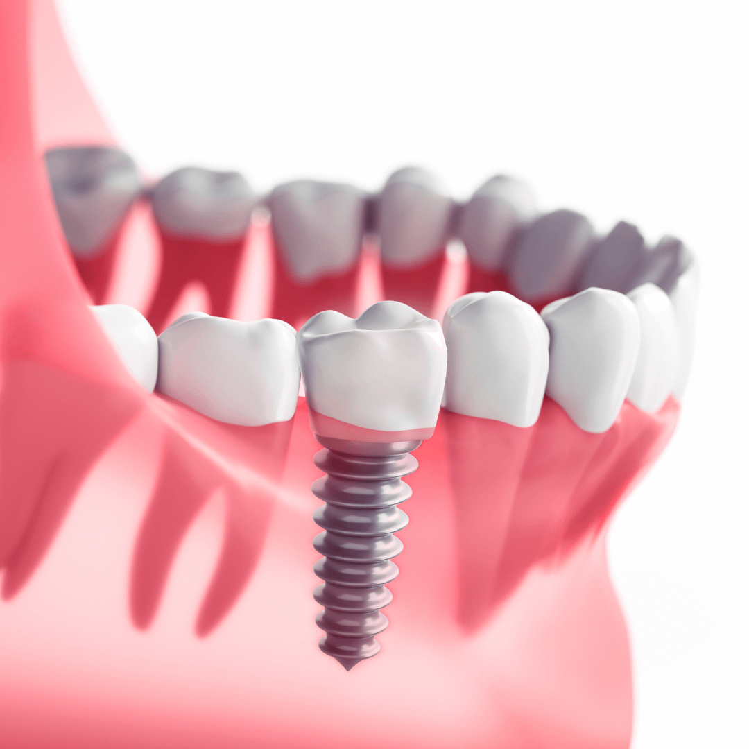 Understanding Dental Implant Surgery: A Guide to Replacing Missing ...
